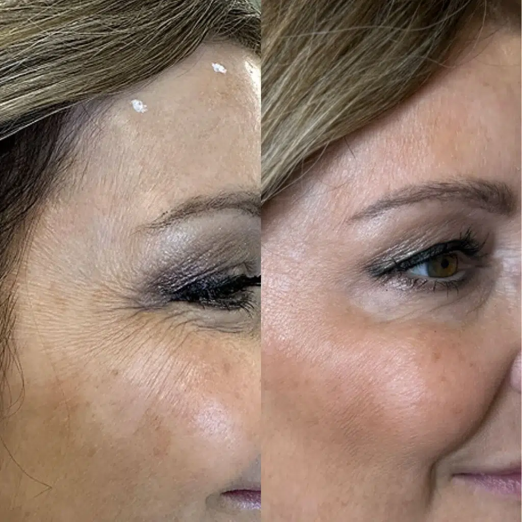 Botox/Dysport Before & After Photos | Monroe MedSpa Syracuse