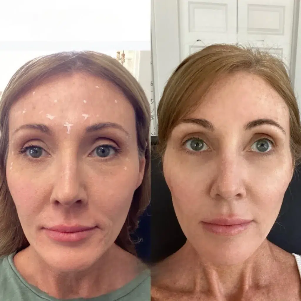 Dermal Fillers Before & After Photos | Monroe MedSpa Syracuse